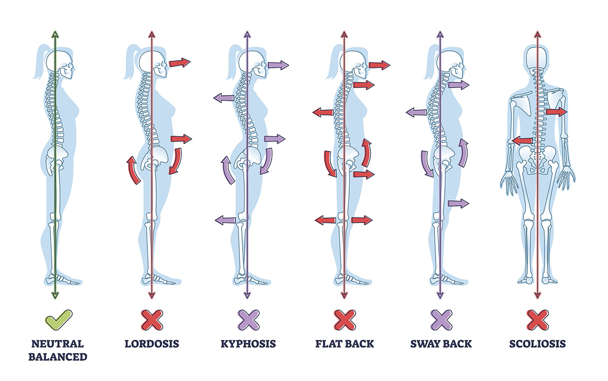Improve Bad Posture & Restore Balance | Causes & Treatment